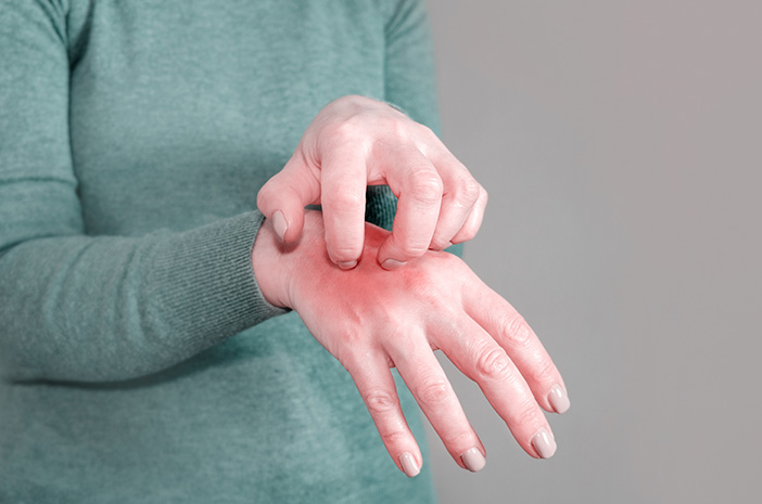 Scabies pada Manusia, Ini Gejala, Cara Penularan, dan Langkah Pengobatannya