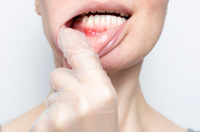 Sariawan di Gusi, Ini Penyebab, Gejala, dan Cara Mengatasinya