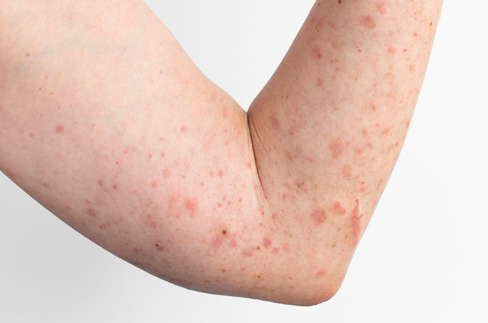 Penyakit Kayap: Gejala, Penyebab, dan Obatnya!