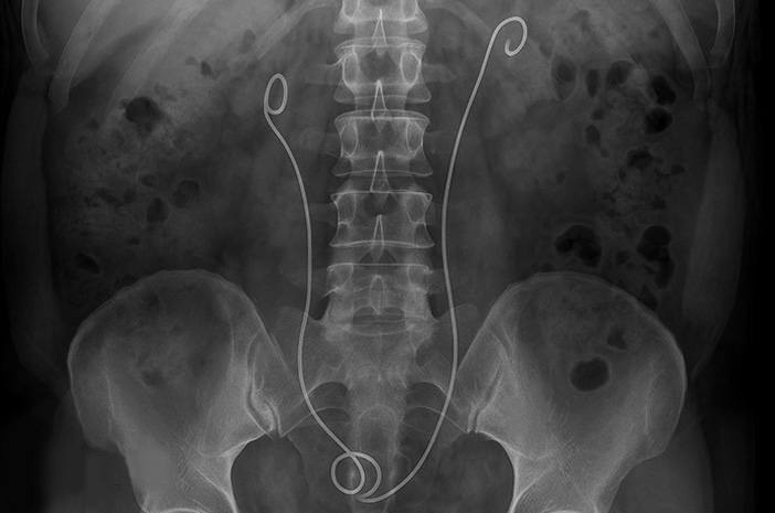 DJ Stent: Fungsi, Prosedur, dan Komplikasi Umum