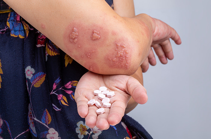 Herpes Zoster: Mengenal ICD 10 dan Pengobatannya