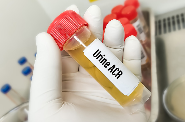 Tes Albumin-Creatinine Ratio (ACR) Urine Sewaktu: Manfaat dan Prosedur ...