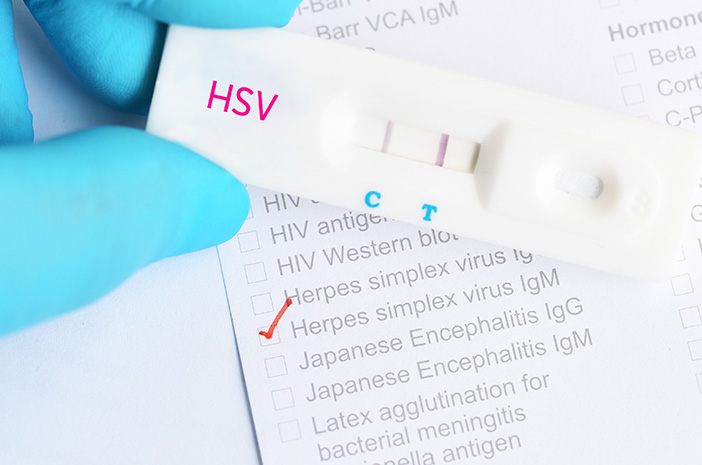 Tes Anti-HSV-1 IgM - Apa Itu, Tujuan, Prosedur, & Interpretasi Hasil