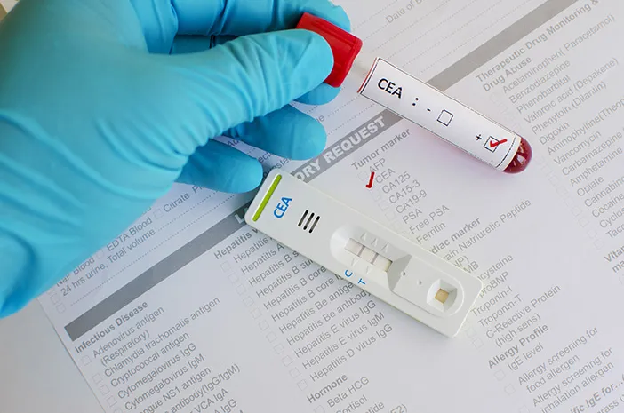 Tes Carcinoembryonic Antigen (CEA) - Pengertian, Manfaat, dan Prosedur ...