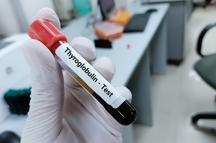 Cek Tiroglobulin - Tujuan, Prosedur, & Interpretasi Hasil