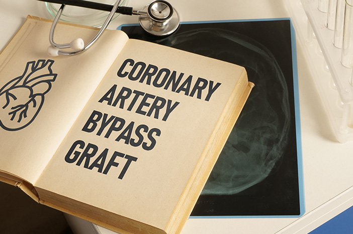 Coronary Artery Bypass Graft (CABG): Kapan Prosedur Ini Diperlukan?