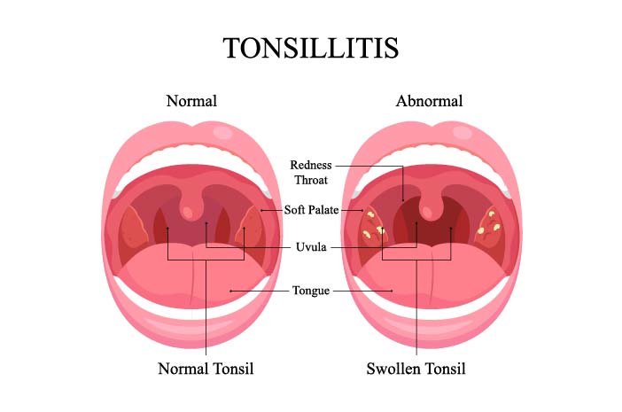 Amandel: Penyebab, Manfaat, dan Cara Mengatasinya