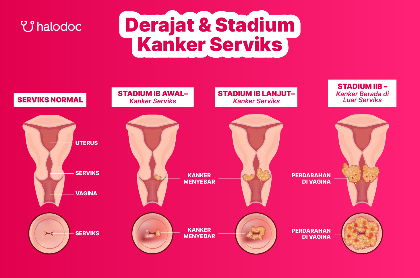 Penting Untuk Wanita, Berikut Ciri-Ciri Kanker Rahim